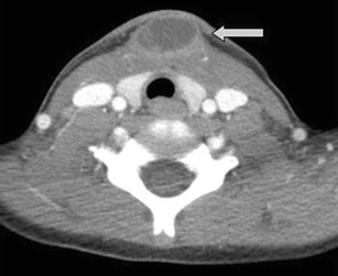 Infected thyroglossal duct cyst | SpringerLink