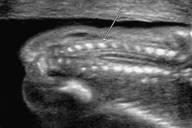 Fetal evaluation of spine dysraphism | SpringerLink