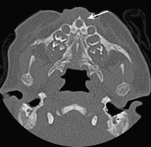 Congenital nasal pyriform aperture stenosis | SpringerLink