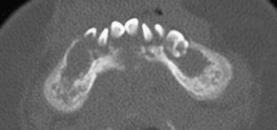 Caffey disease | SpringerLink