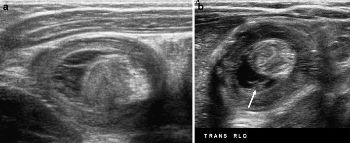 Interloop fluid in intussusception: what is its significance ...