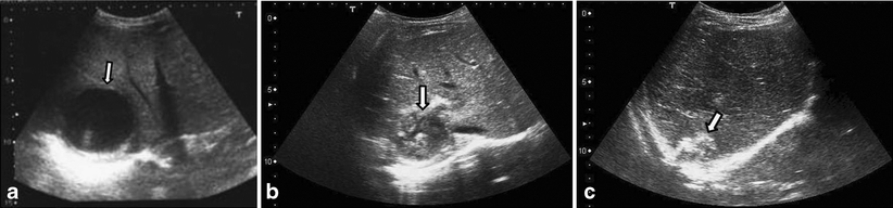 Hydatid cysts of the liver in children: percutaneous treatment with ...