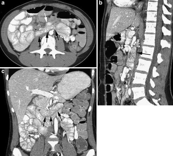 CT appearance of the duodenum and mesenteric vessels in children with ...