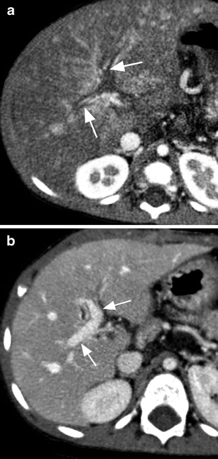 Pre- and postoperative imaging and interventions for the meso-Rex ...