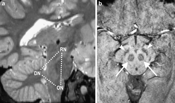 Red nucleus degeneration in hypertrophic olivary degeneration after ...