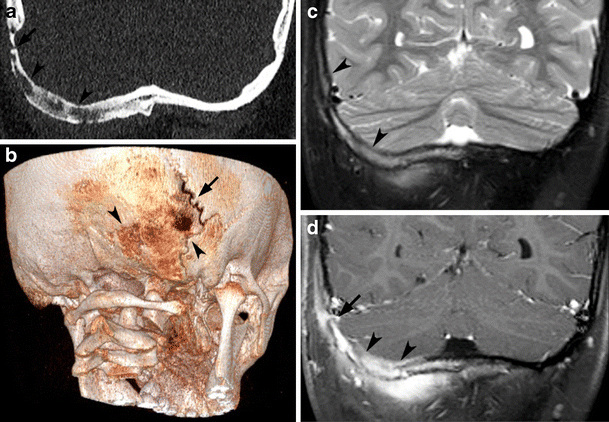Skull base osteomyelitis and potential cerebrovascular complications in ...