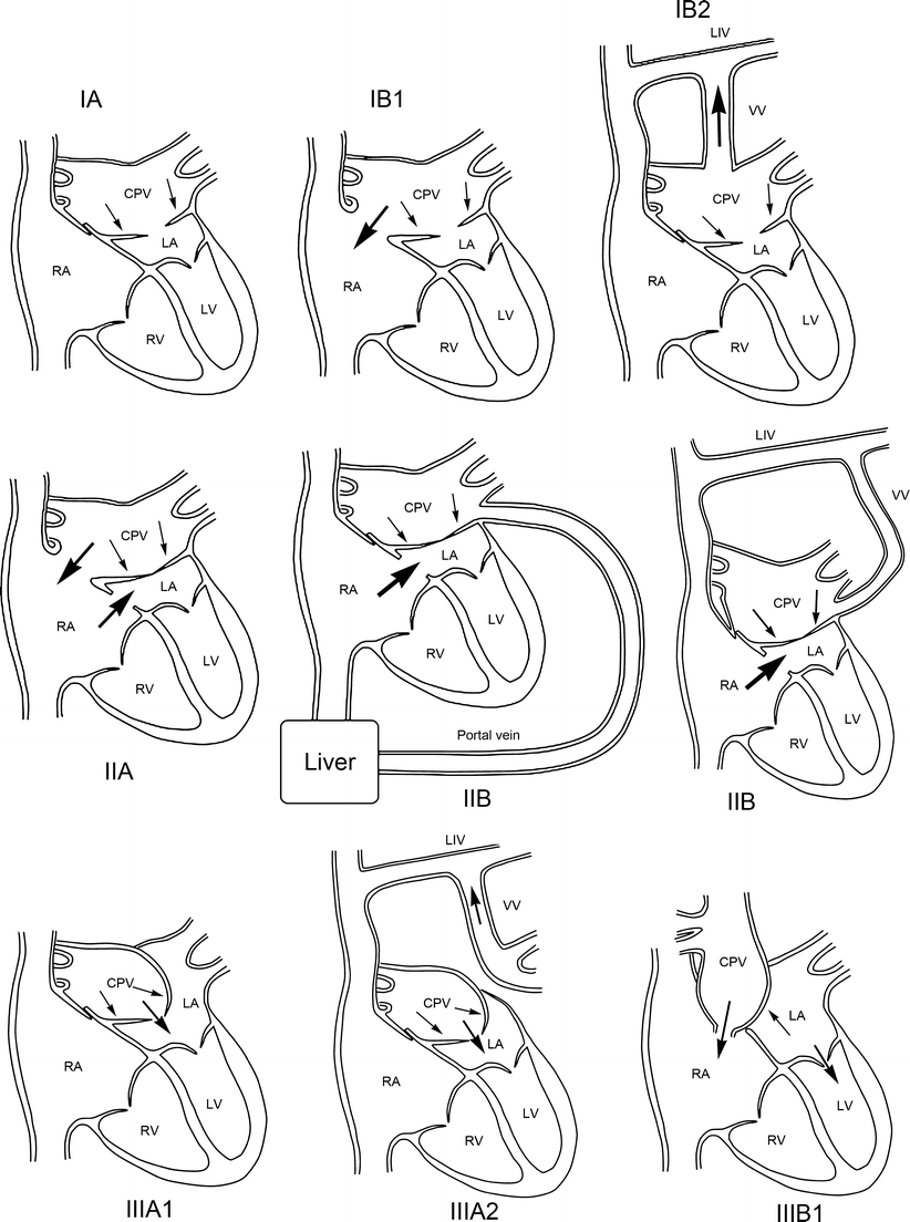 Cor triatriatum sinister versus bowed septum primum in an infant with ...