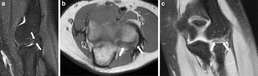 Elbow plica syndrome: presenting with elbow locking in a pediatric ...