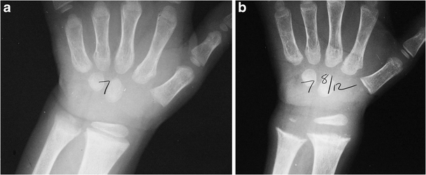 Rickets: Part II | SpringerLink