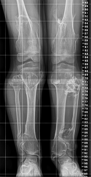 Growth arrest and leg-length discrepancy | SpringerLink