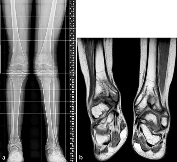 Growth arrest and leg-length discrepancy | SpringerLink