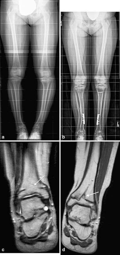 Growth arrest and leg-length discrepancy | SpringerLink
