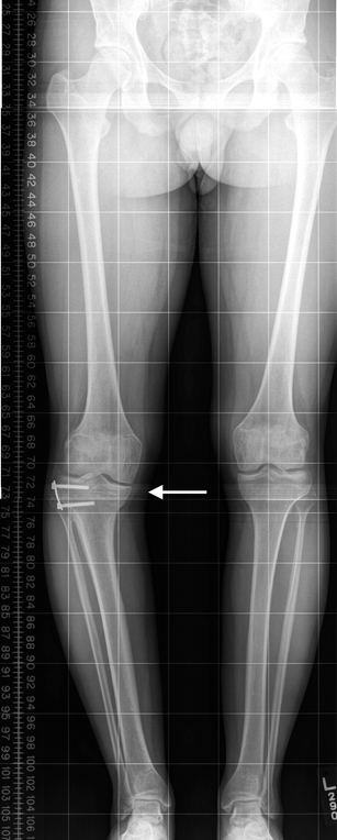 Growth arrest and leg-length discrepancy | SpringerLink