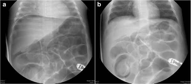 Needle decompression to avoid tension pneumoperitoneum and hemodynamic ...