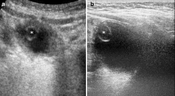 Imaging features of intravesical urachal cysts in children | SpringerLink