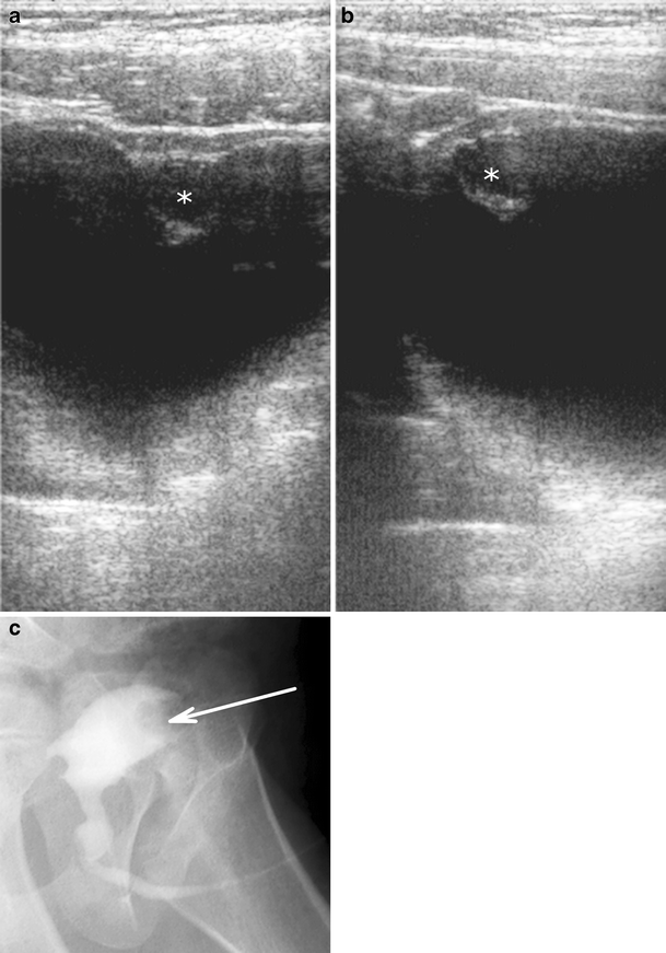 Imaging features of intravesical urachal cysts in children | SpringerLink