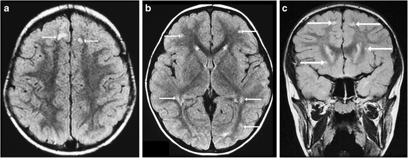 Genetically proven cerebral autosomal-dominant arteriopathy with ...
