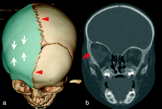Craniosynostosis: imaging review and primer on computed tomography ...