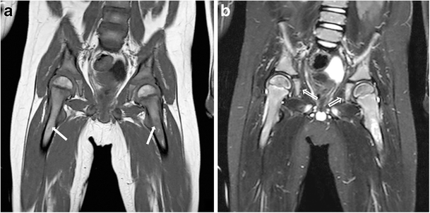 Scurvy in an autistic child: MRI findings | SpringerLink