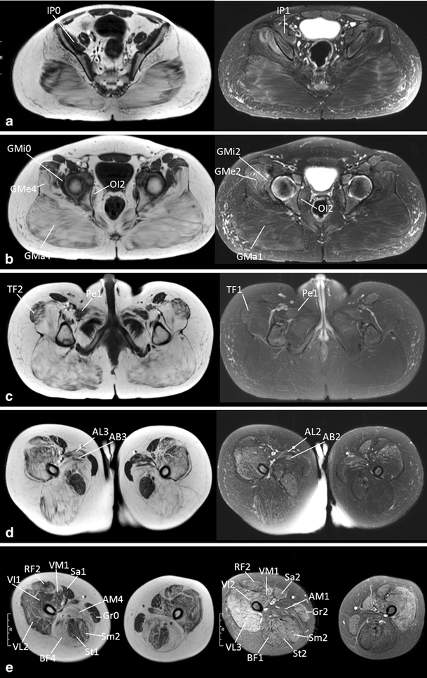 Analysis of fatty infiltration and inflammation of the pelvic and thigh ...