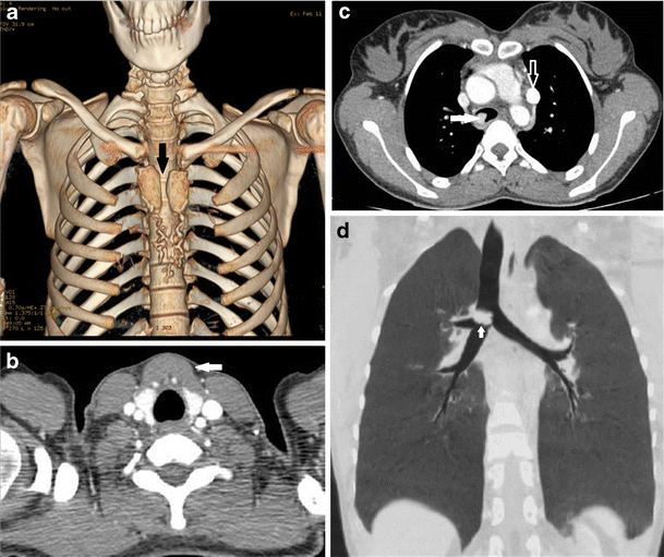 PHACES syndrome associated with carcinoid endobronchial tumor ...