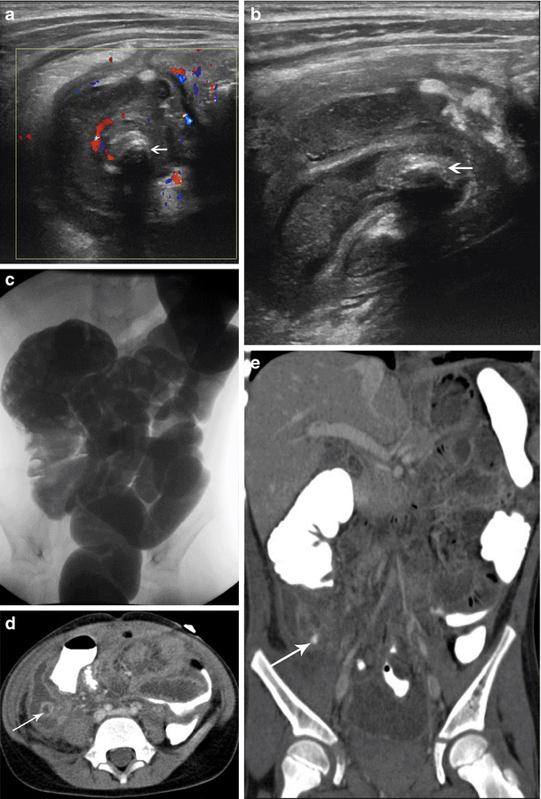 Perforated appendicitis: an underappreciated mimic of intussusception ...