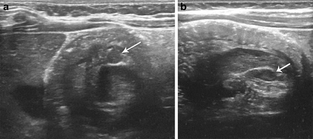Perforated appendicitis: an underappreciated mimic of intussusception ...