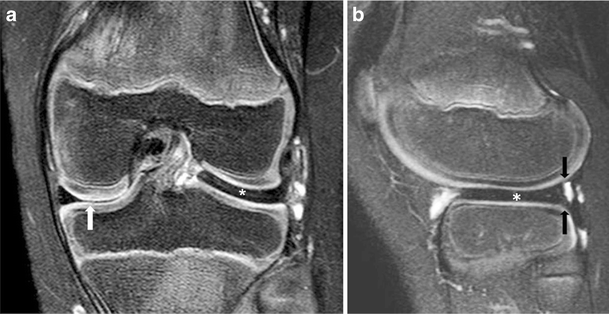Meniscal pathology in children: differences and similarities with the ...