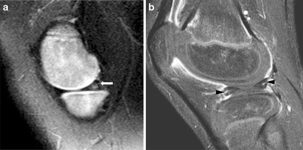 Meniscal pathology in children: differences and similarities with the ...