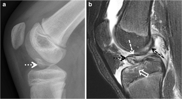 Avulsion fractures of the pediatric knee | SpringerLink