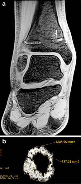 Imaging of physeal bars in children | SpringerLink
