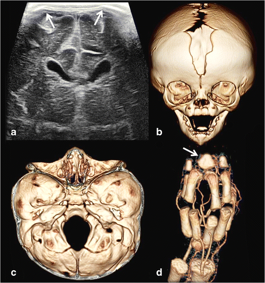 Skull base development and craniosynostosis | SpringerLink