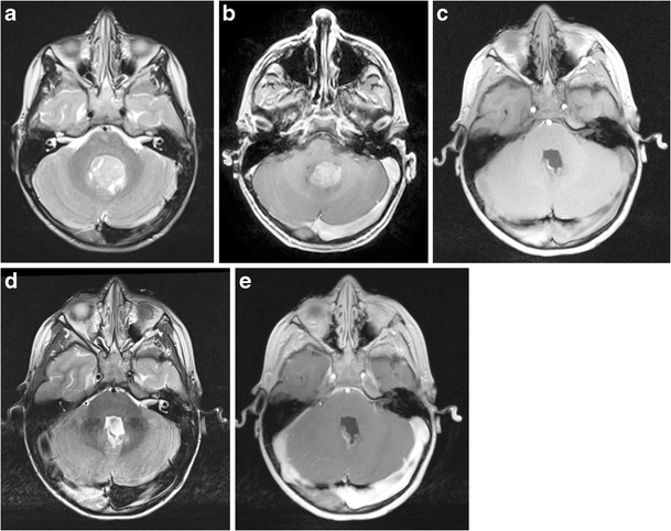 Intraoperative MRI in pediatric brain tumors | SpringerLink