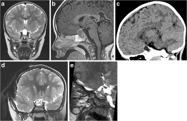 Intraoperative MRI in pediatric brain tumors | SpringerLink