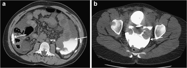 The role of imaging in pediatric bladder augmentation | SpringerLink
