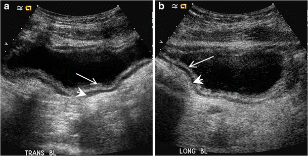 The role of imaging in pediatric bladder augmentation | SpringerLink