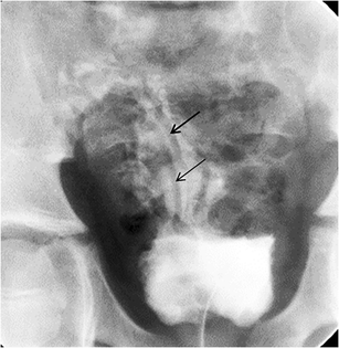 The role of imaging in pediatric bladder augmentation | SpringerLink