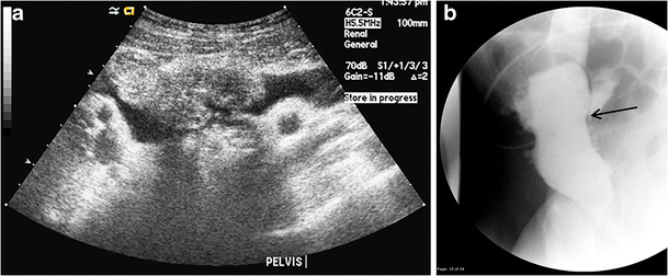 The role of imaging in pediatric bladder augmentation | SpringerLink
