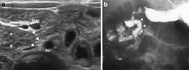 Ultrasound of the duodenum in children | SpringerLink