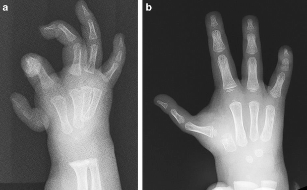 Radiographic assessment of congenital malformations of the upper ...