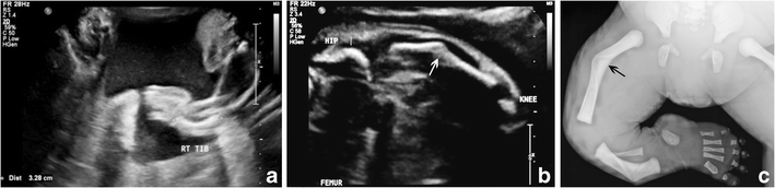 Evaluating skeletal dysplasias on prenatal ultrasound: an emphasis on ...