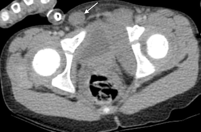 Canal of Nuck hernia: a multimodality imaging review | SpringerLink