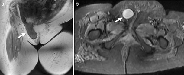 Canal Of Nuck Hernia A Multimodality Imaging Review Springerlink
