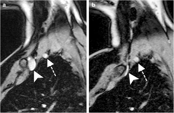 MRI of thoracic outlet syndrome in children | SpringerLink