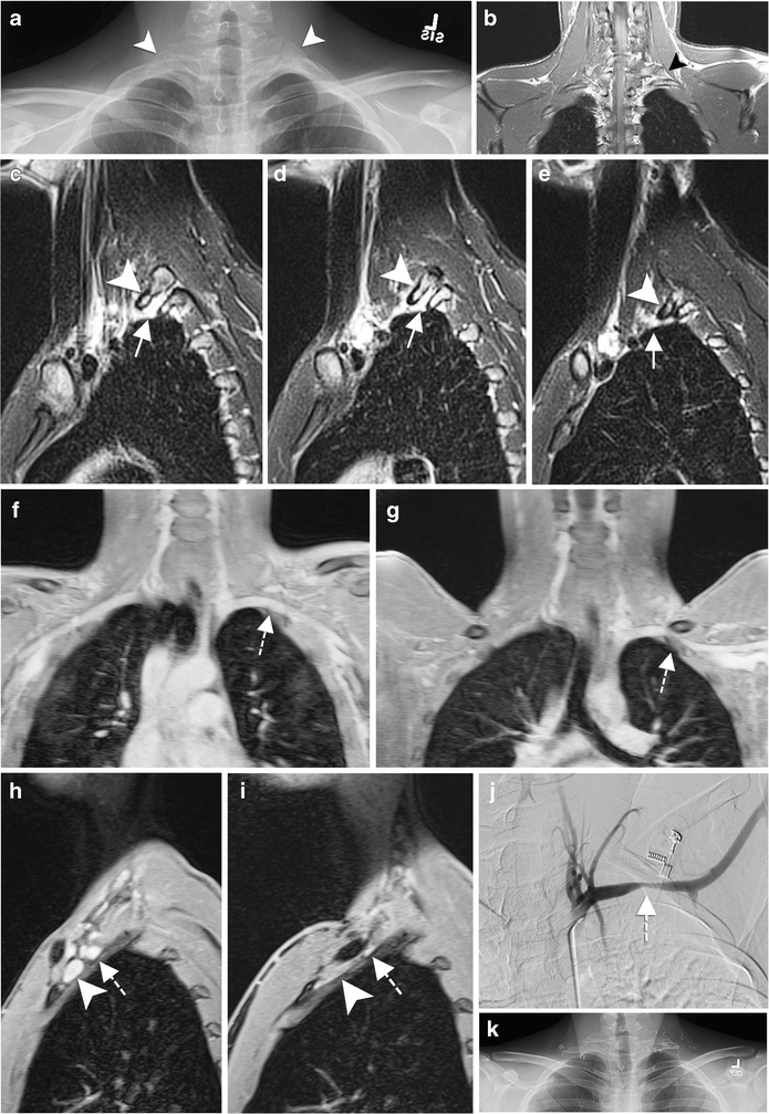 MRI of thoracic outlet syndrome in children | SpringerLink