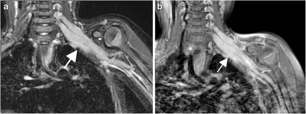 MRI of thoracic outlet syndrome in children | SpringerLink