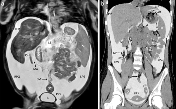 Imaging of the pediatric peritoneum, mesentery and omentum | SpringerLink
