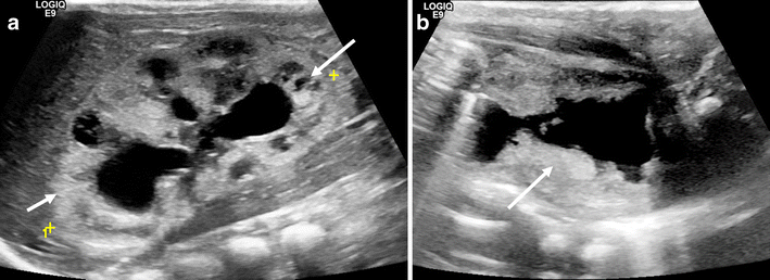Classification of pediatric urinary tract dilation: the new language ...
