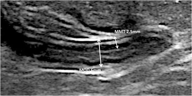 Ultrasound of the pediatric appendix | SpringerLink