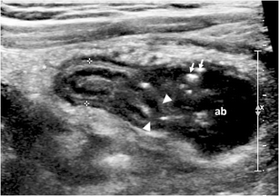 Ultrasound of the pediatric appendix | SpringerLink